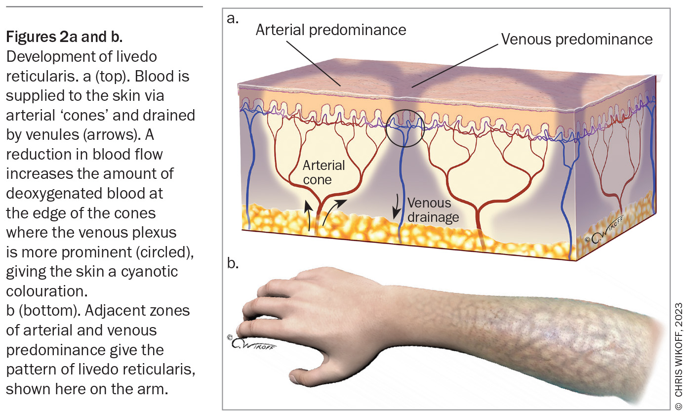 Reticulated hyperpigmentation and erythema on the legs | Medicine Today